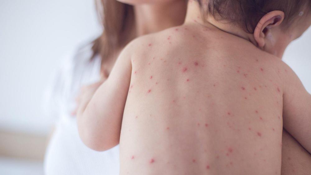 Agregan Una Segunda Dosis De La Vacuna Contra La Varicela Al Calendario